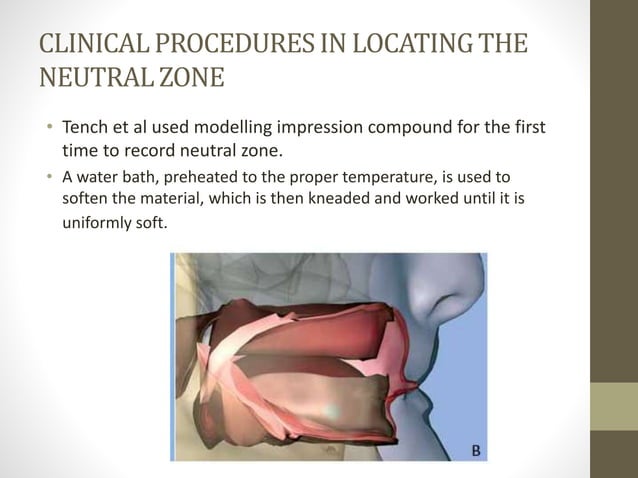 Neutral zone in complete dentures | PPTX | Dental Health | Diseases and ...