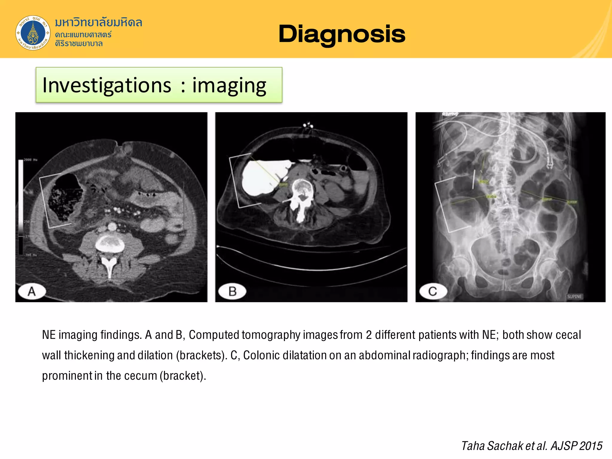 Neutropenic colitis, Typhlitis | PDF