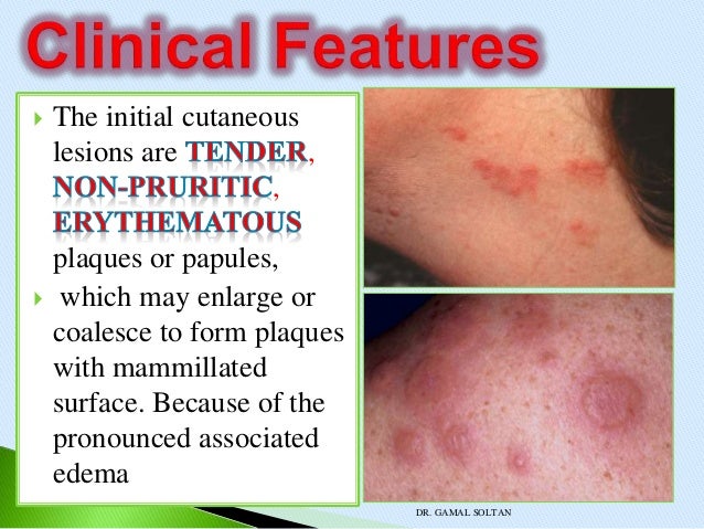Neutrophilic Dermatosis