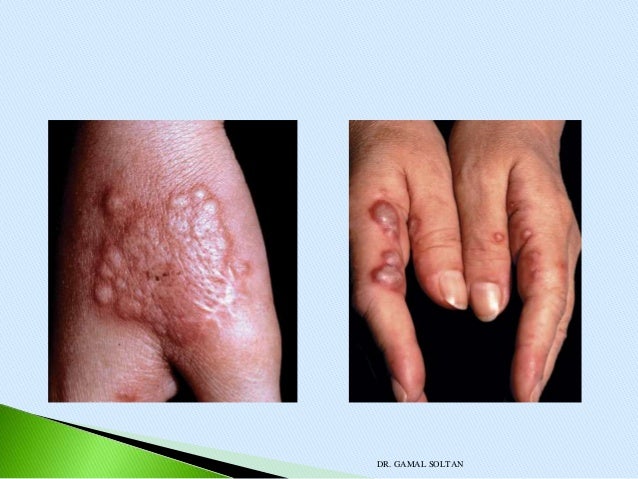 Neutrophilic dermatosis