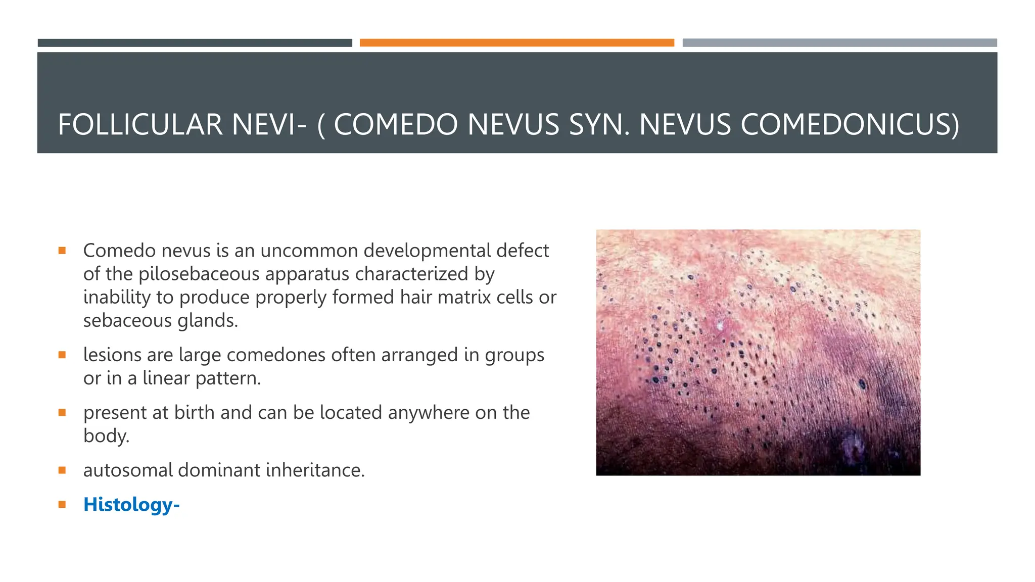 Nevi disorders and other defects.pp dermatolgytx | PPTX