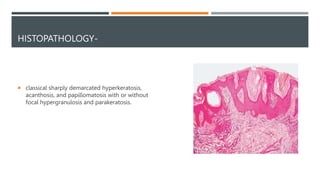 Nevi disorders and other defects.pp dermatolgytx | PPTX