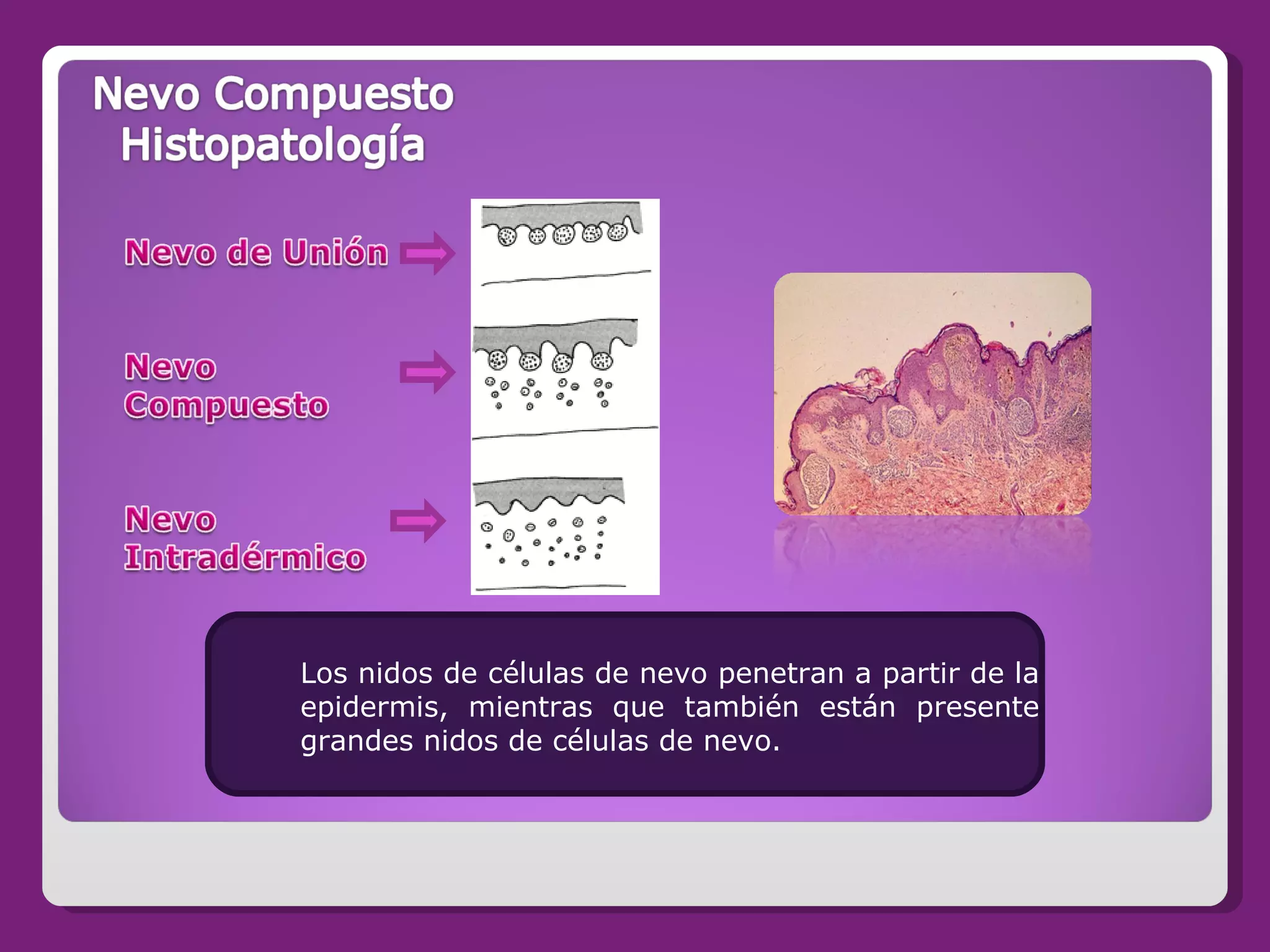 Nevo Celular Pigmentado | PPT | Skin and Dermatology | Diseases and ...