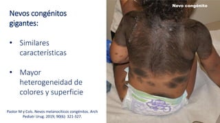 Nevo Melanocítico Congénito | PPTX