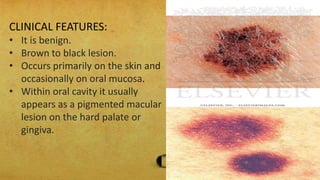 Nevus | PPTX