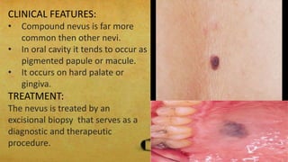 Blue Nevus Oral
