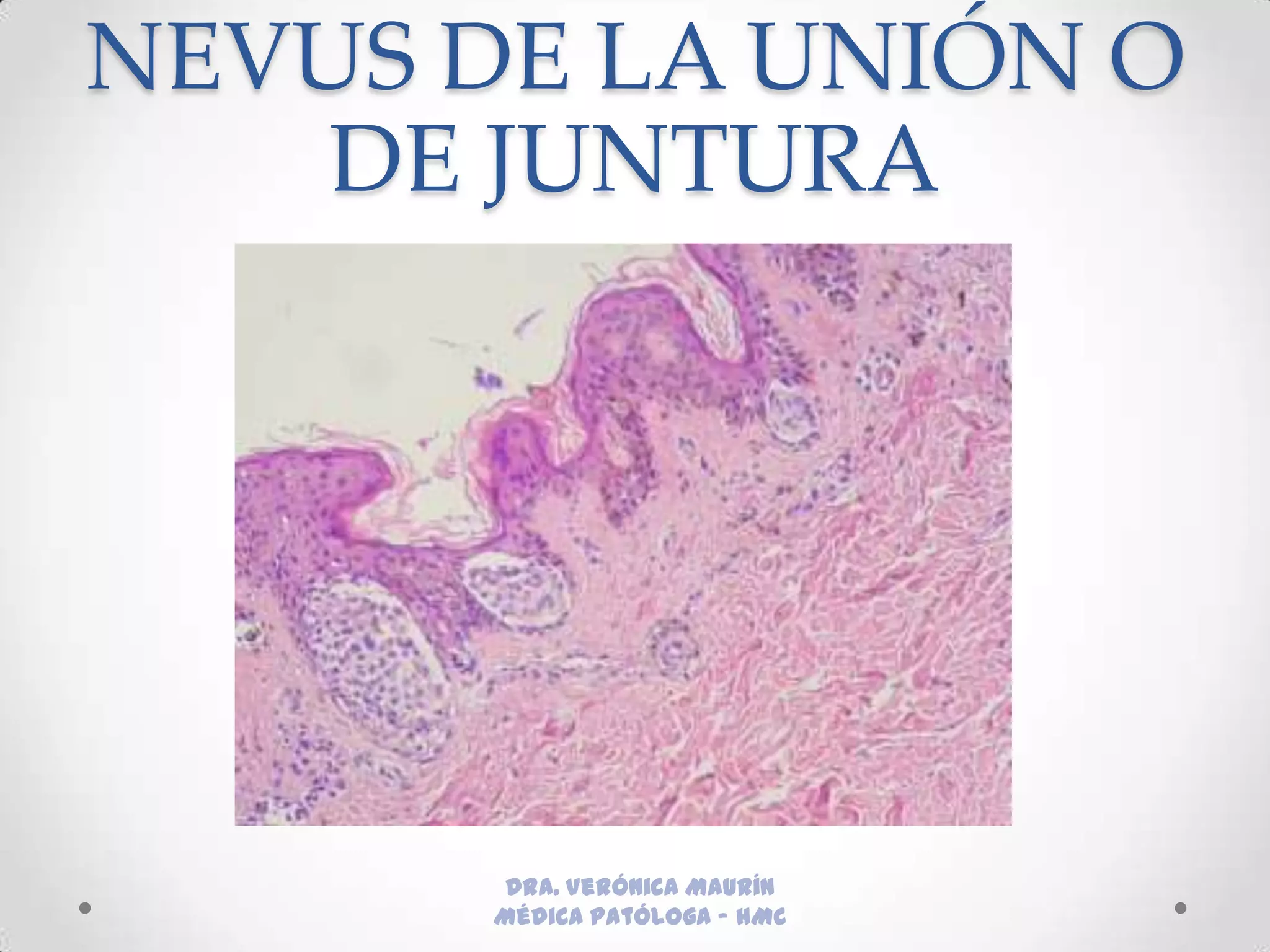 Nevus | PPT
