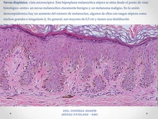 Nevus | PPTX