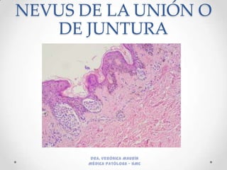 Nevus | PPTX