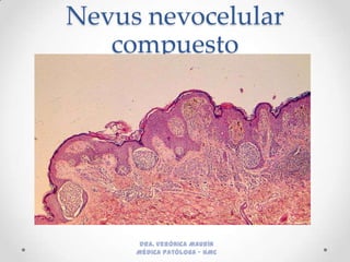 Nevus | PPTX