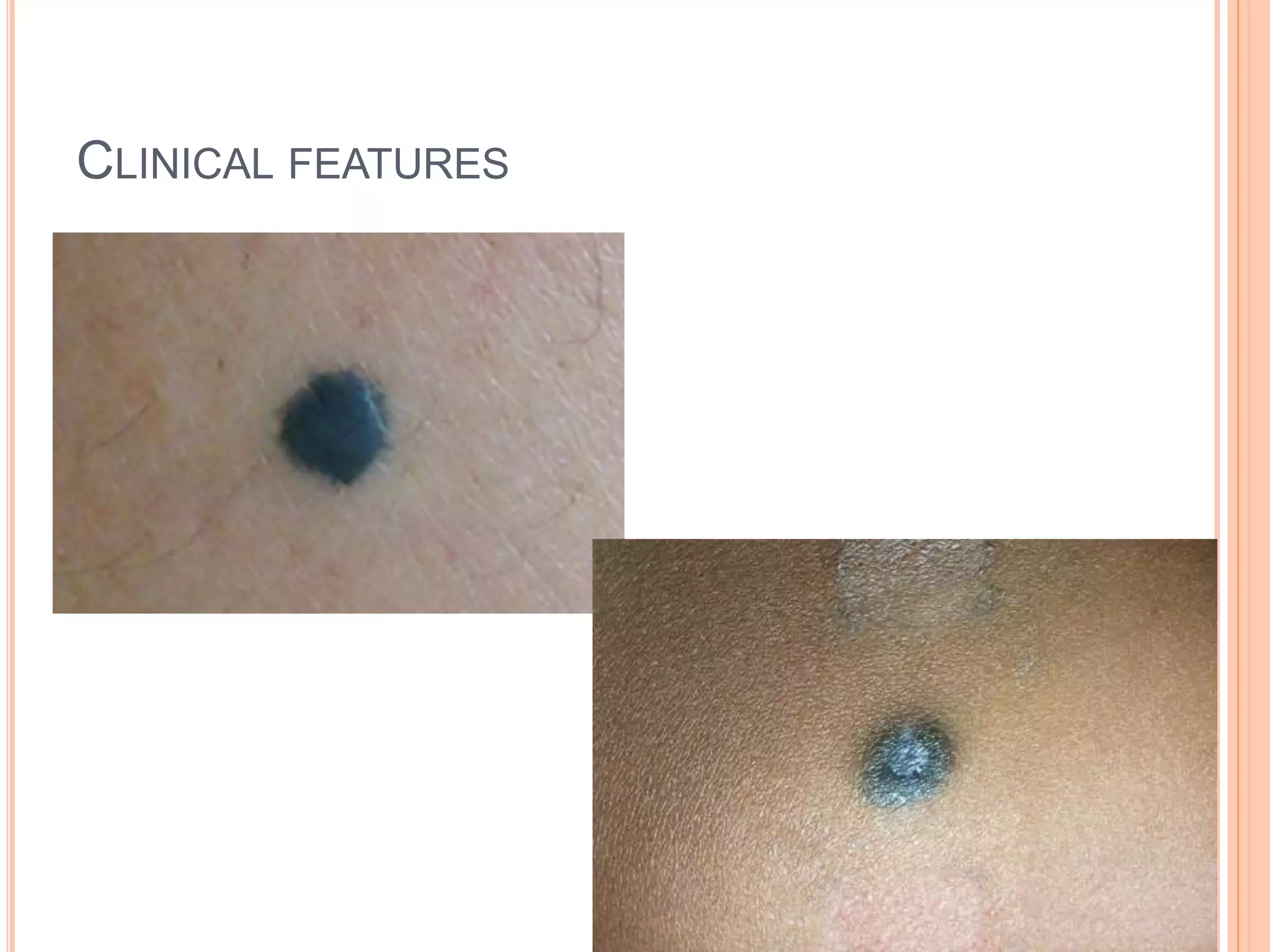 Nevus | PPTX