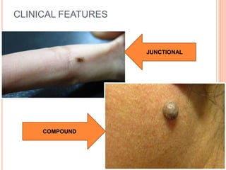 Nevus | PPTX