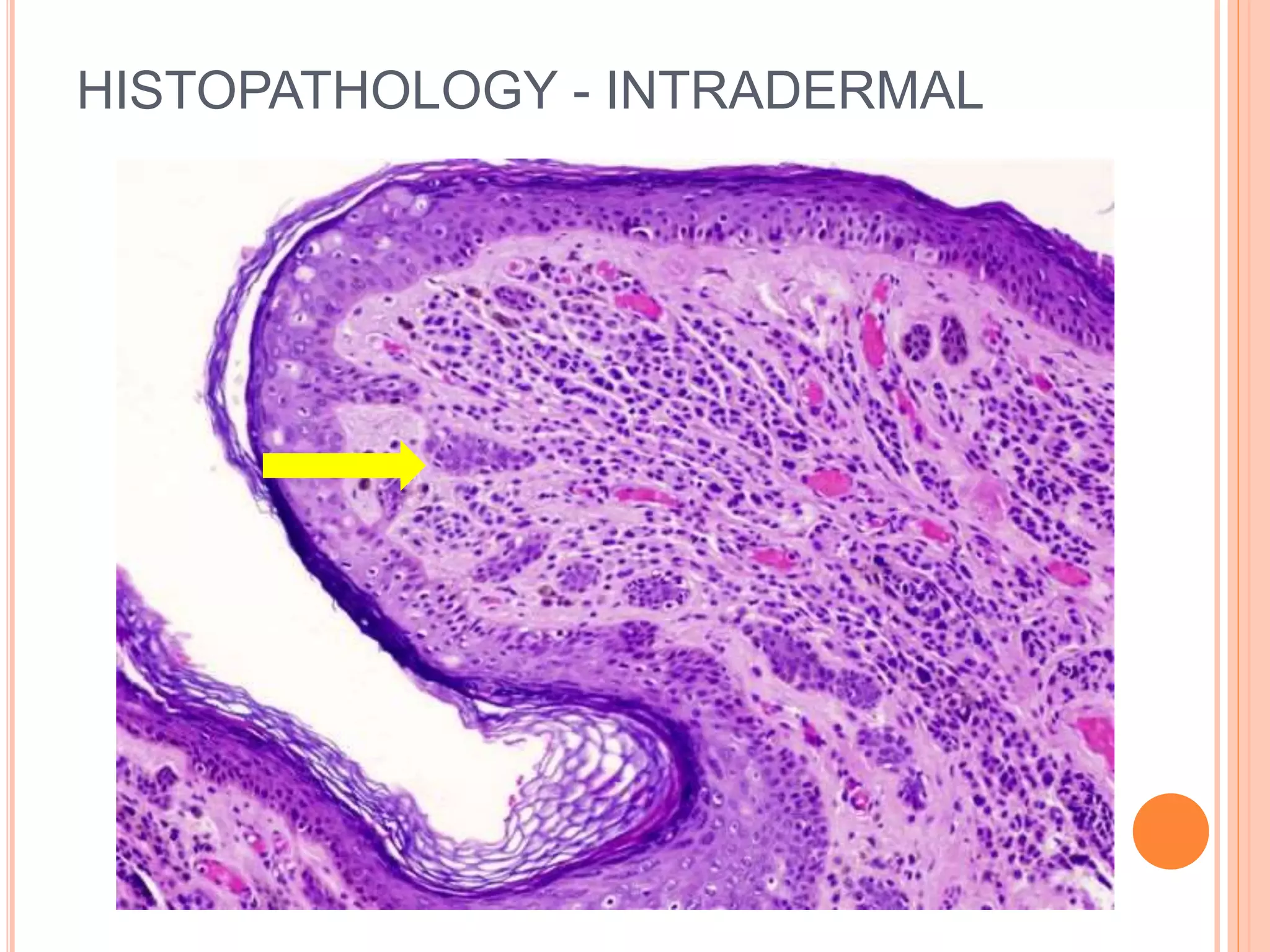 Nevus | PPTX