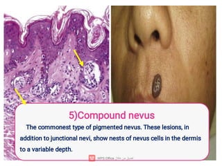 nevus .pdf