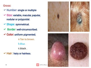 nevus .pdf
