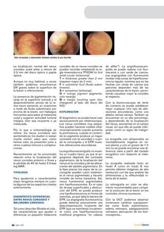 Nevus coroideos | PDF