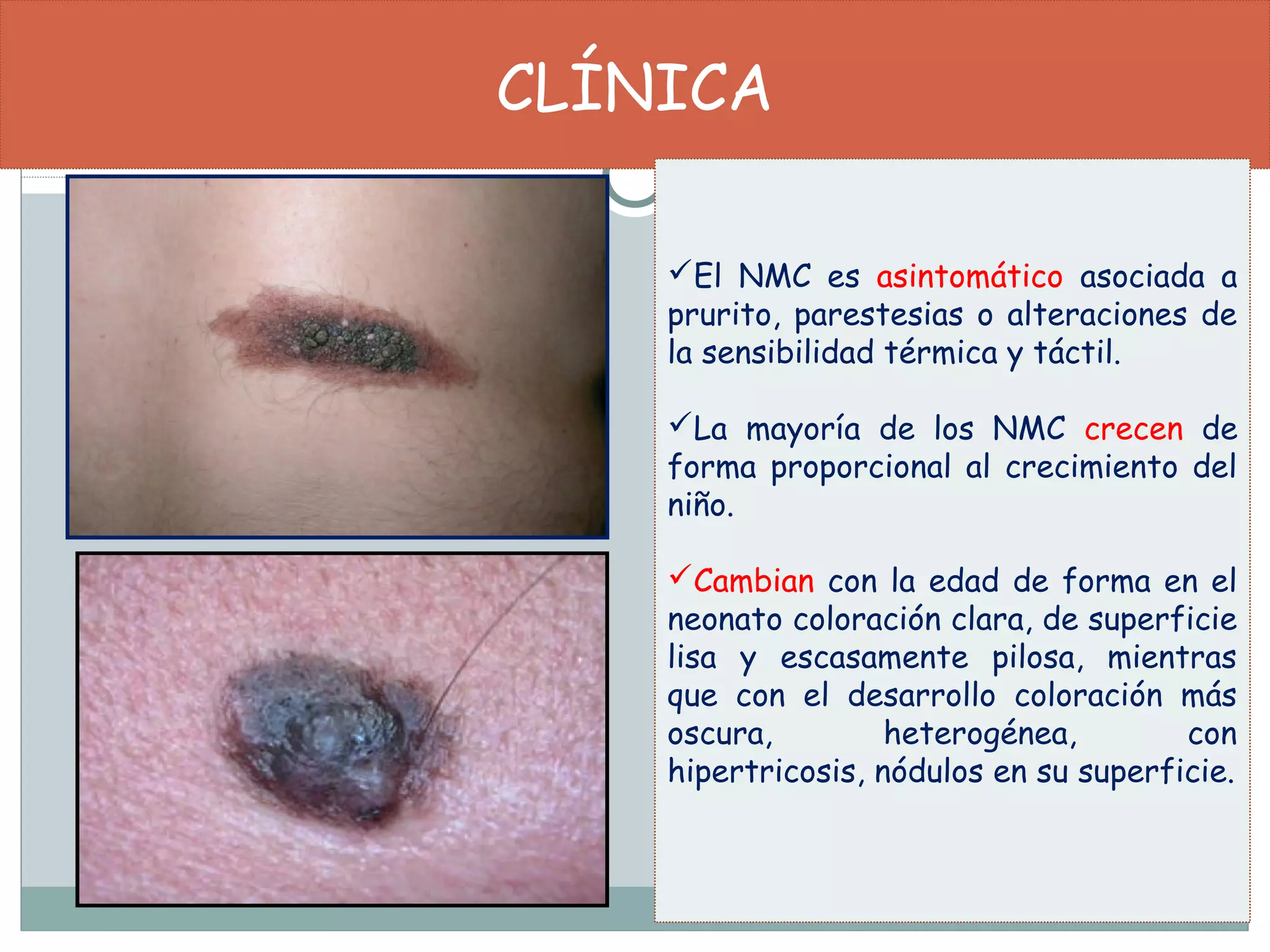 Nevus melanocitico congenito, diagnostico y tratamiento | PPT