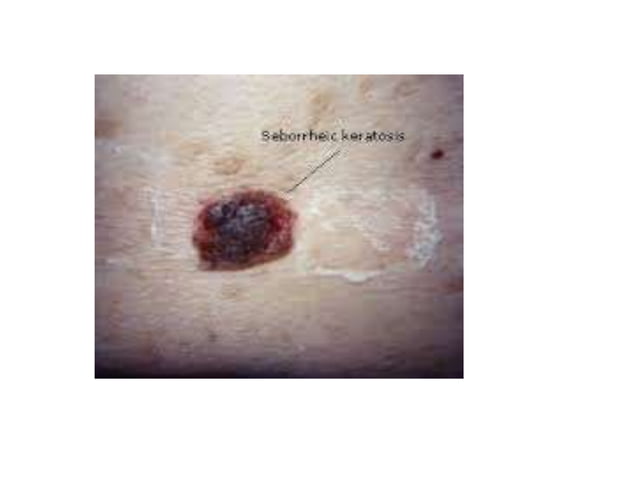 Nevus pigmentosus | PPTX