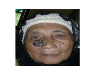 Nevus pigmentosus | PPTX