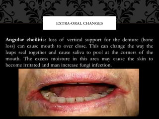 Problems associated with denture wearing and problems associated with ...