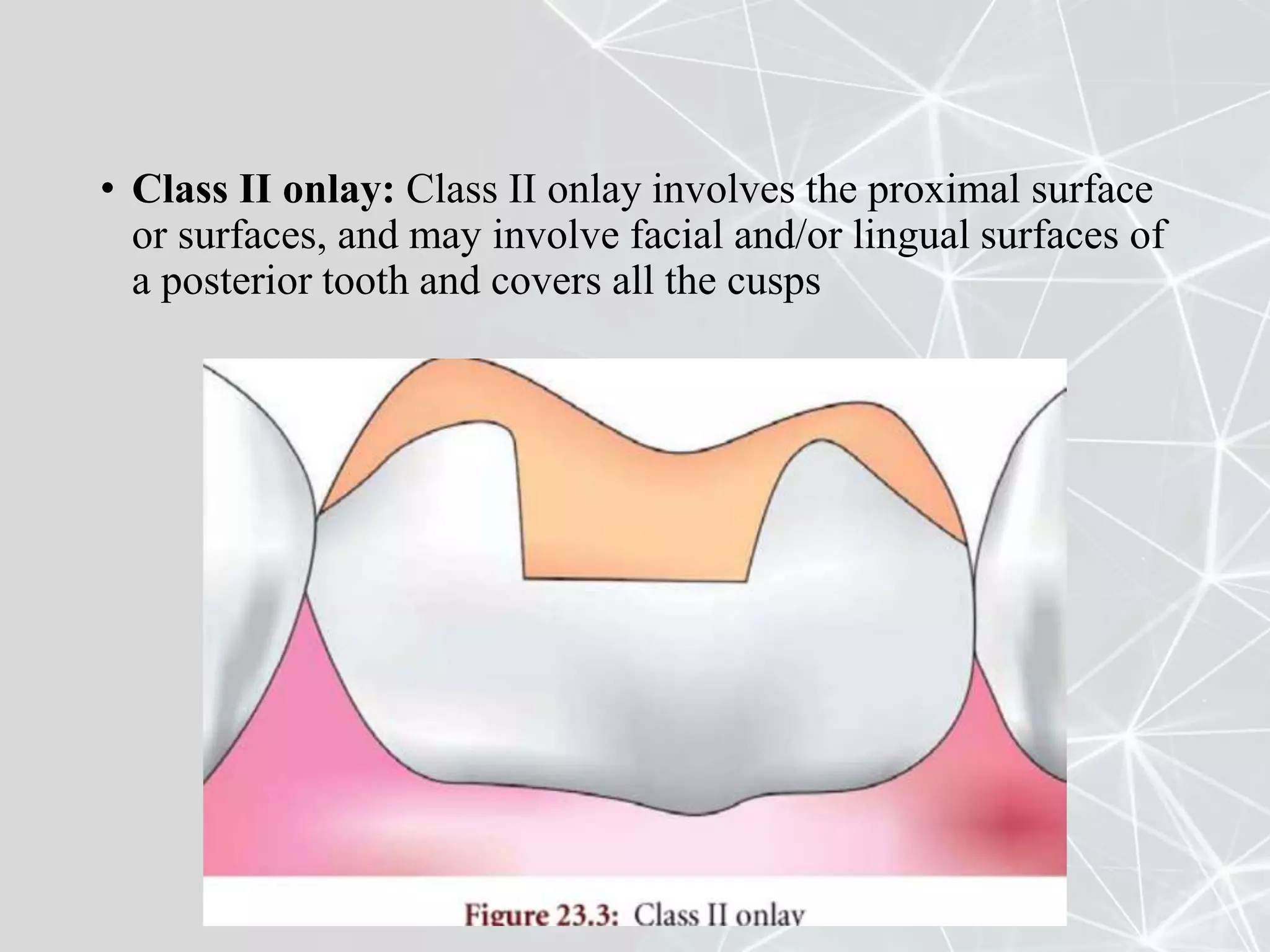 Indirect composite restorations | PPTX