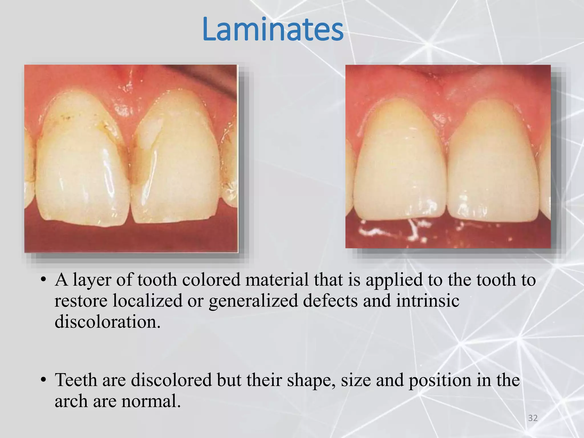 Indirect composite restorations | PPTX