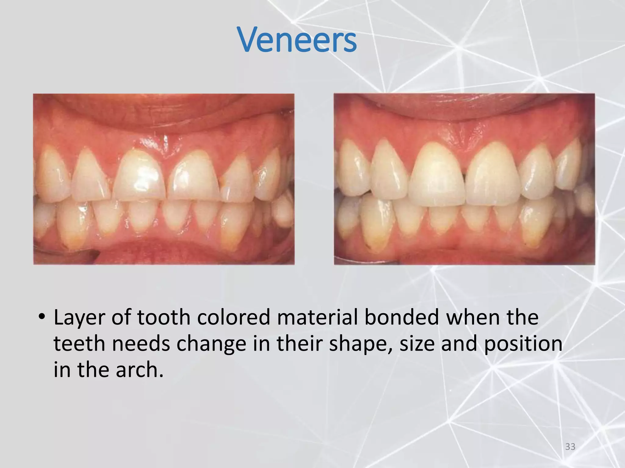 Indirect composite restorations | PPTX