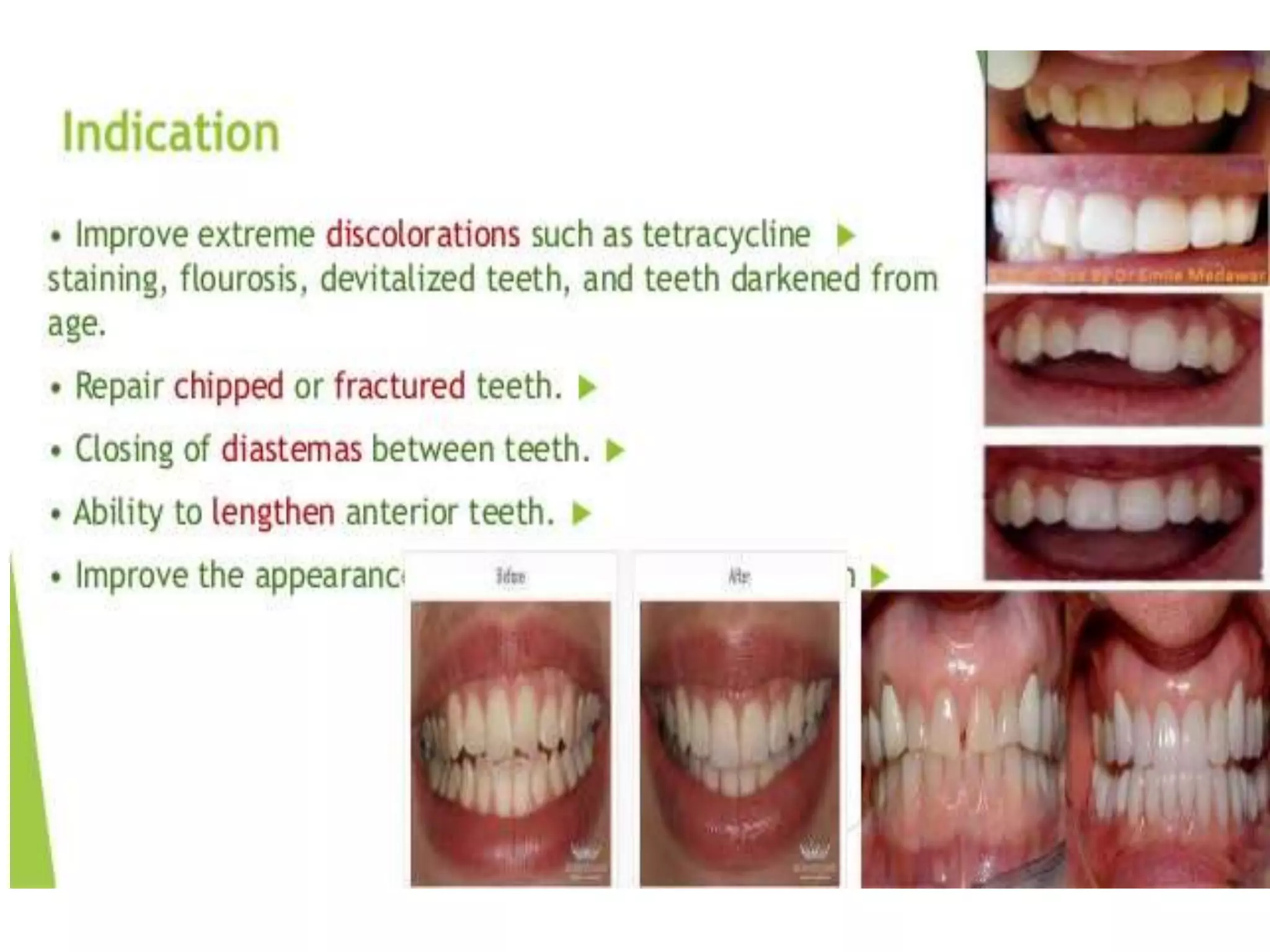 Indirect composite restorations | PPTX