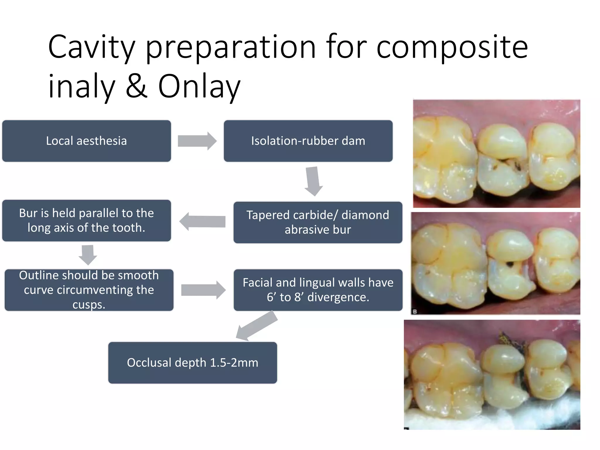 Indirect composite restorations | PPTX