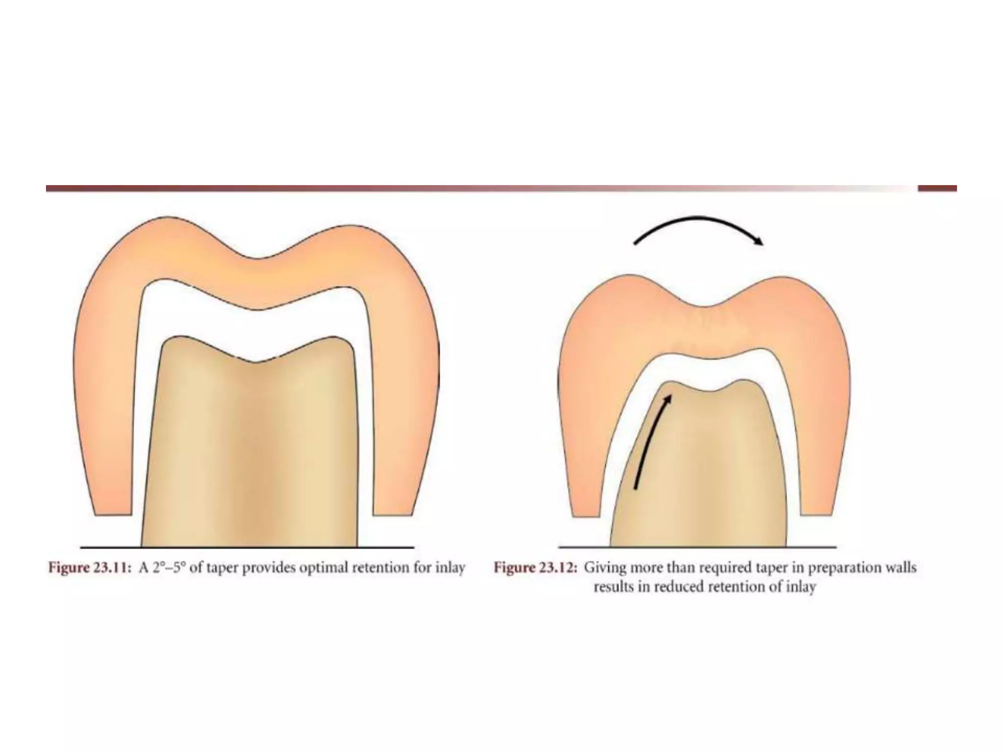 Indirect composite restorations | PPTX