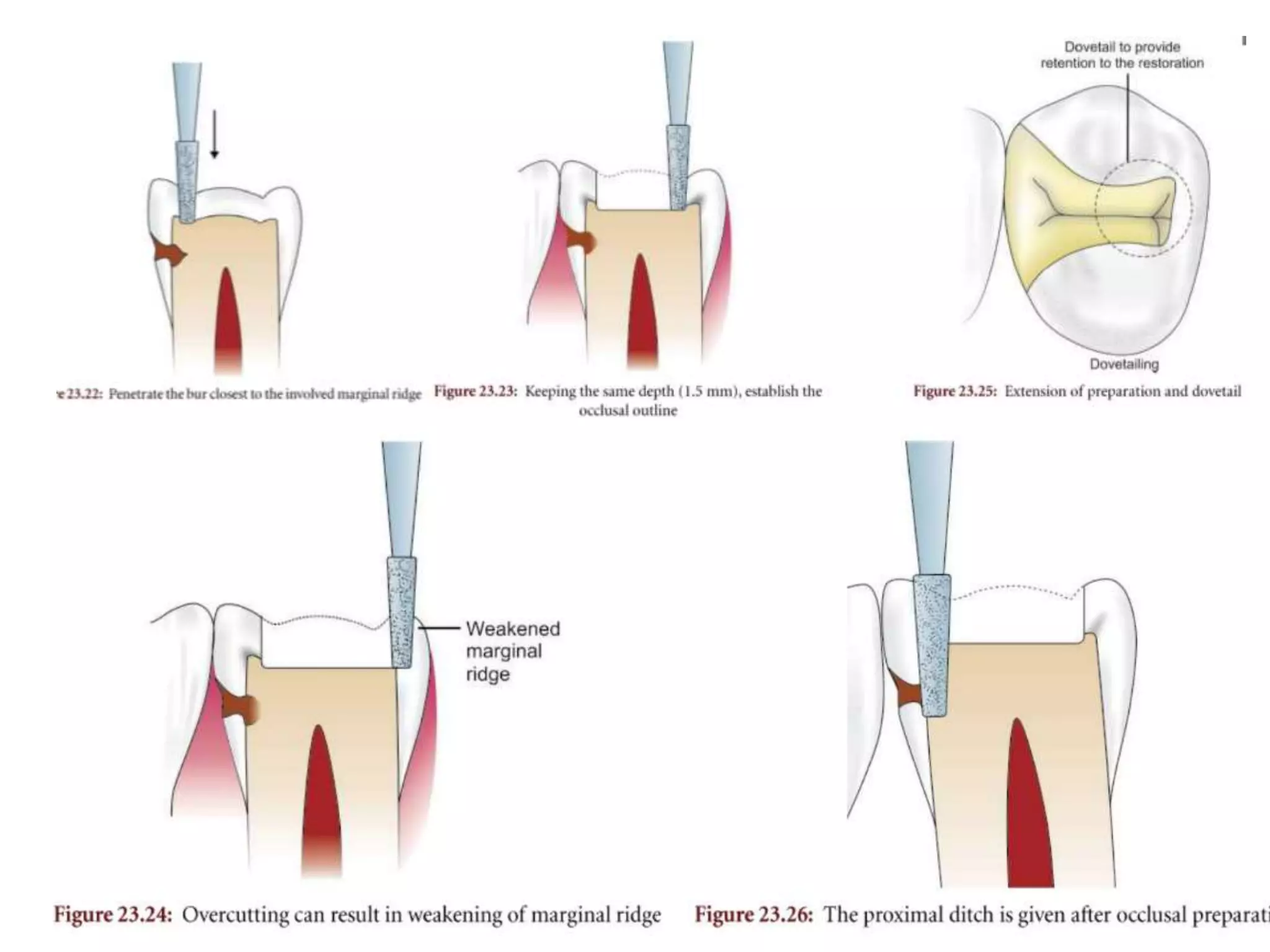 Indirect composite restorations | PPTX