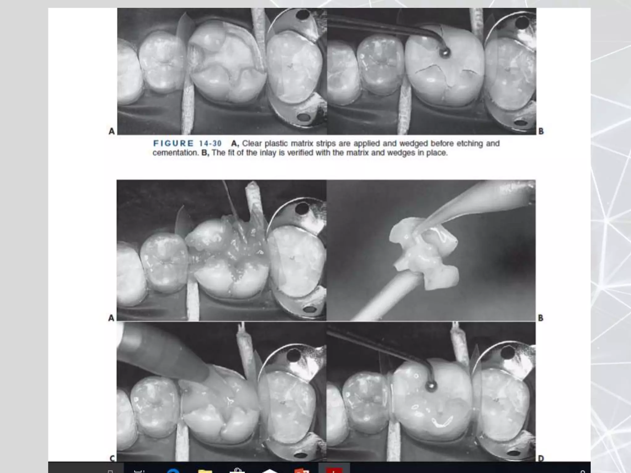 Indirect composite restorations | PPTX