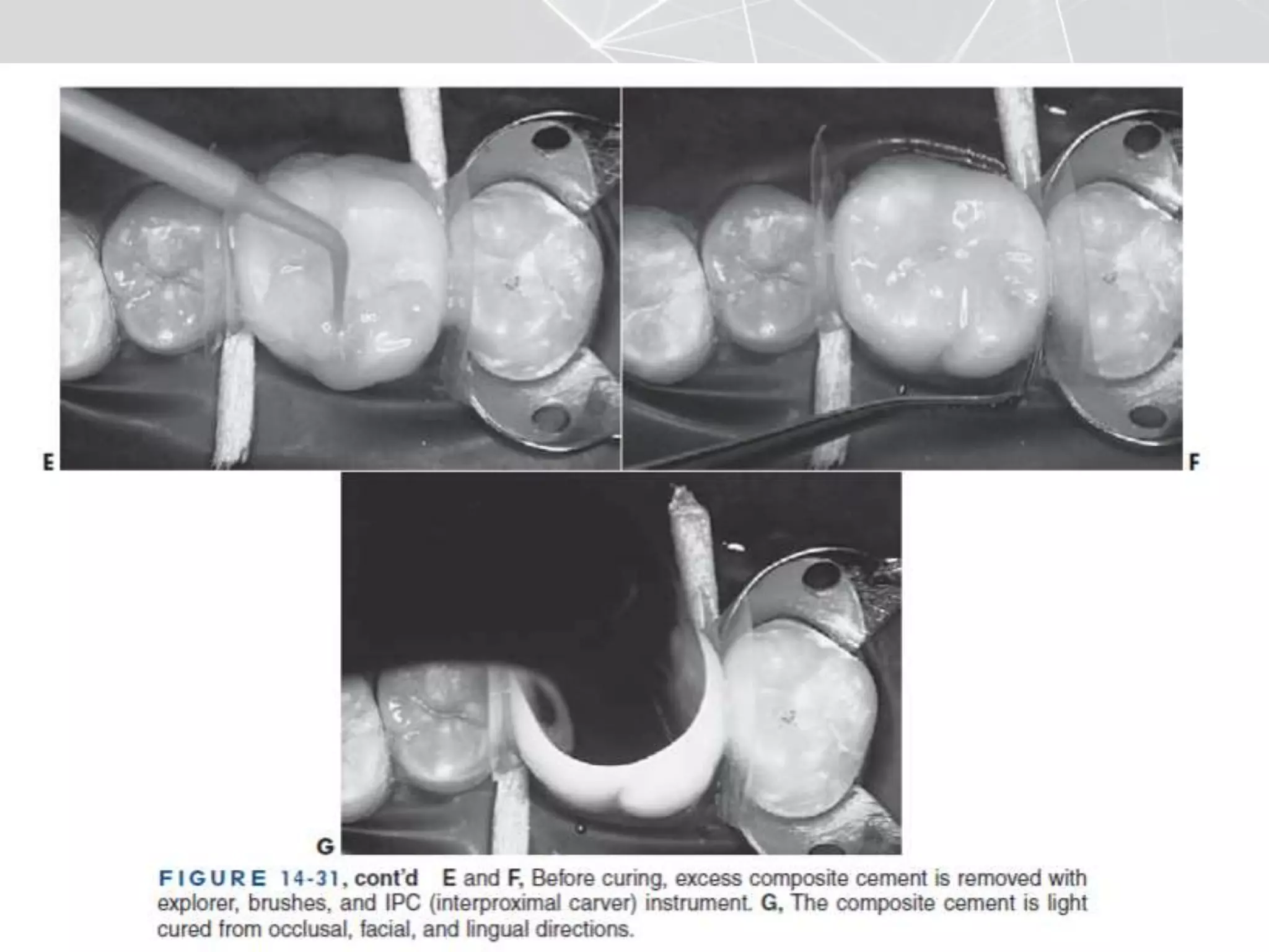 Indirect composite restorations | PPTX