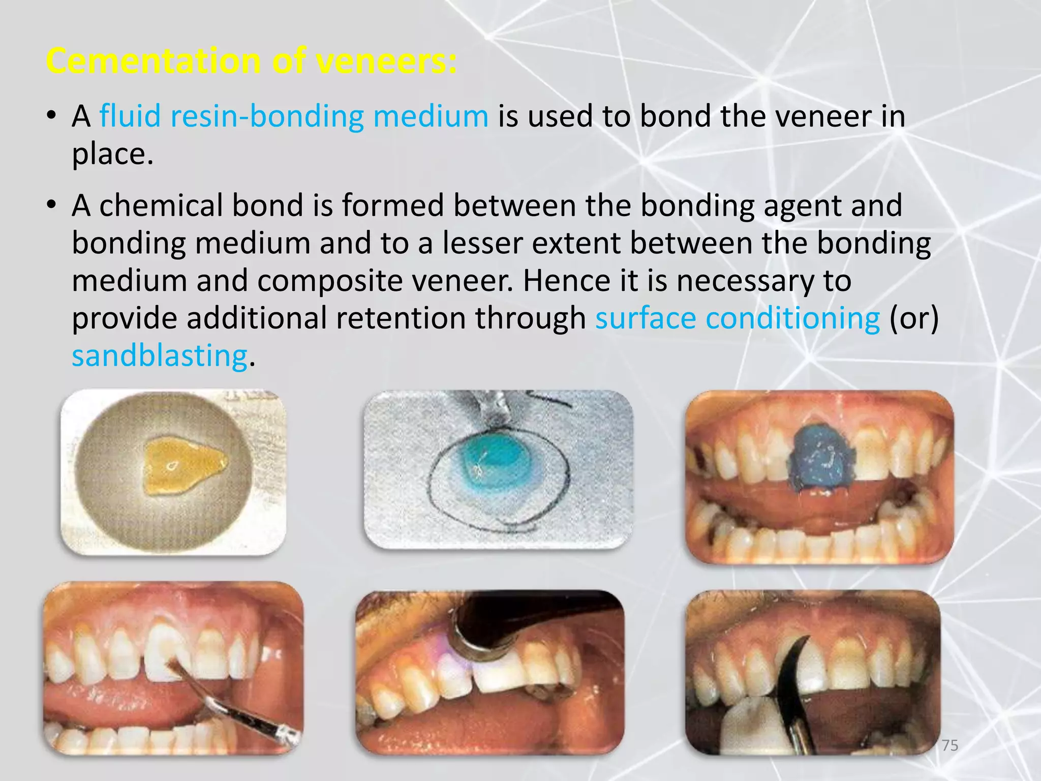 Indirect Composite Restorations Pptx