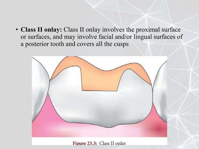 Indirect composite restorations | PPTX | Oral care | Personal Care