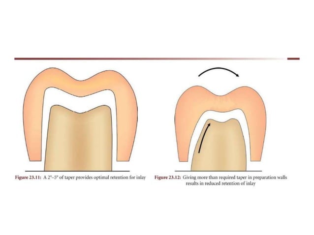 Indirect composite restorations | PPTX | Oral care | Personal Care