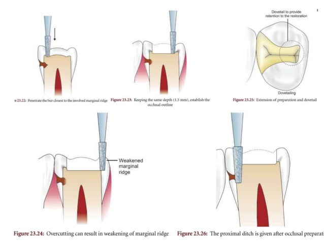 Indirect composite restorations | PPTX | Oral care | Personal Care