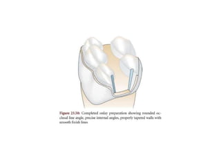 Indirect composite restorations | PPTX