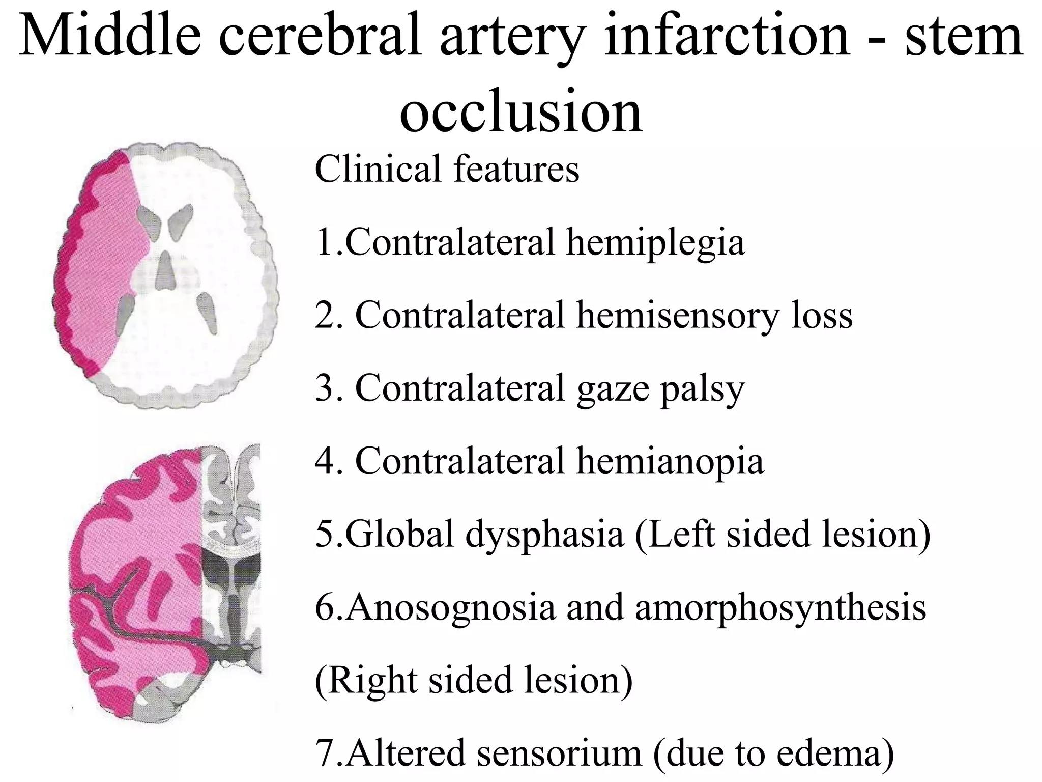 localization of stroke, CVS, stroke, for post graduates | PPT
