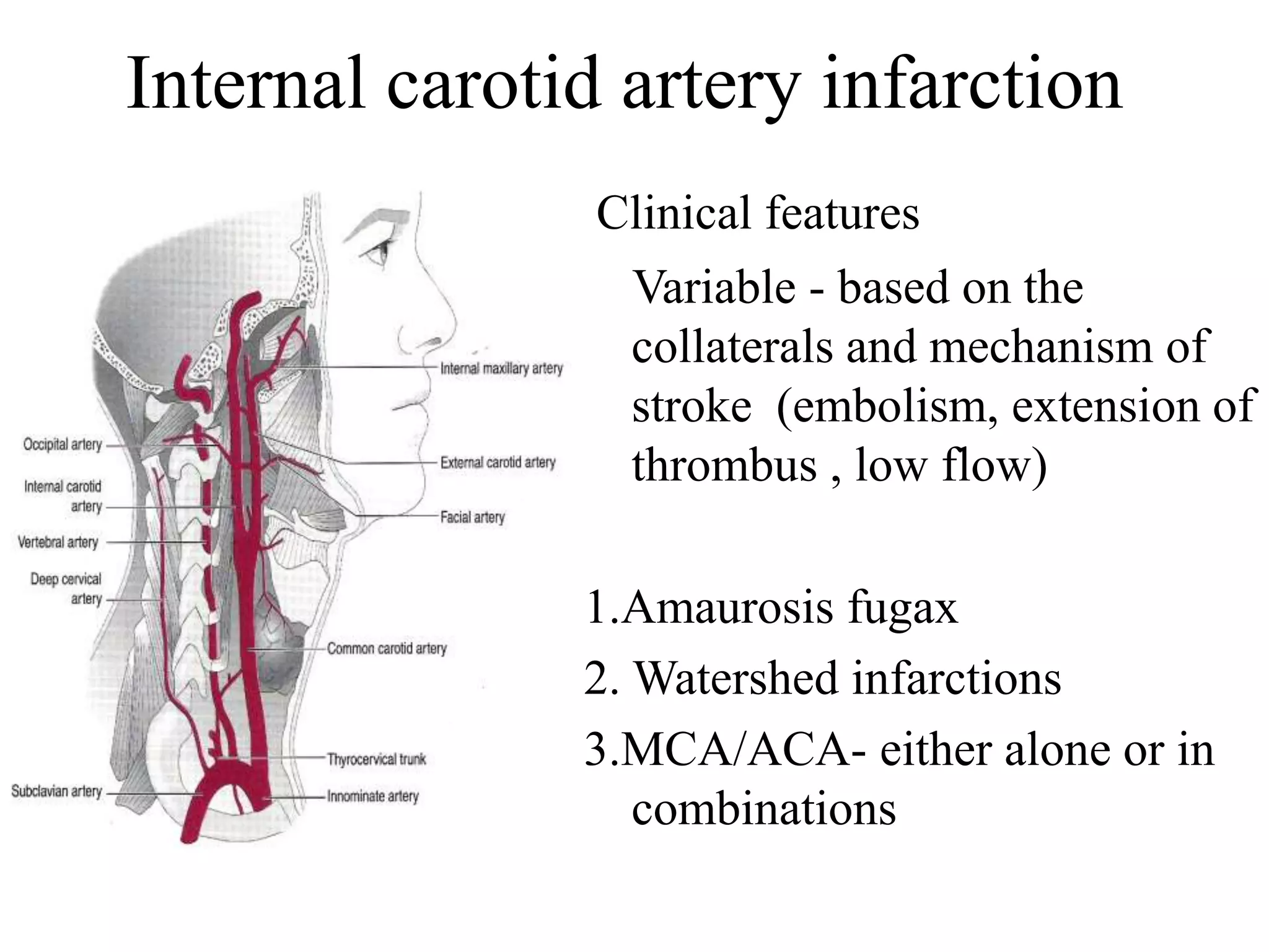 localization of stroke, CVS, stroke, for post graduates | PPT