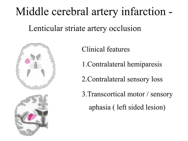 localization of stroke, CVS, stroke, for post graduates | PPT