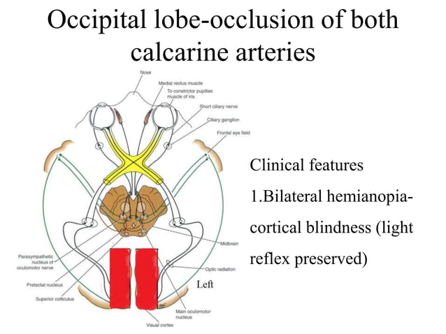localization of stroke, CVS, stroke, for post graduates | PPT