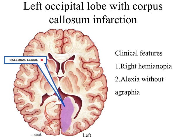 localization of stroke, CVS, stroke, for post graduates | PPT