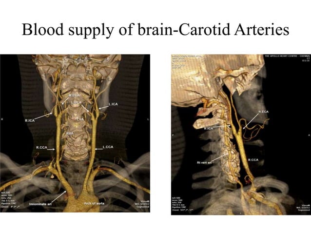 localization of stroke, CVS, stroke, for post graduates | PPT