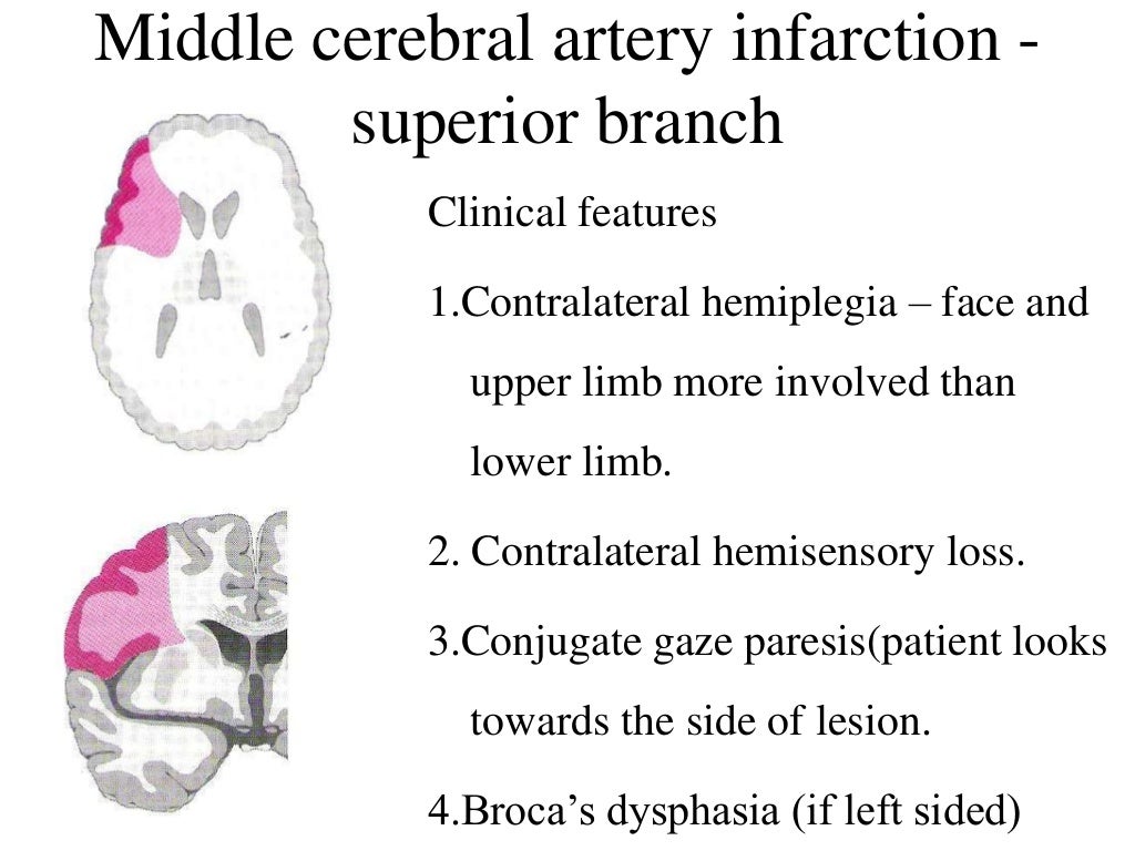 localization of stroke, CVS, stroke, for post graduates