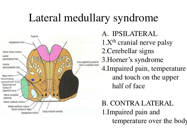 localization of stroke, CVS, stroke, for post graduates