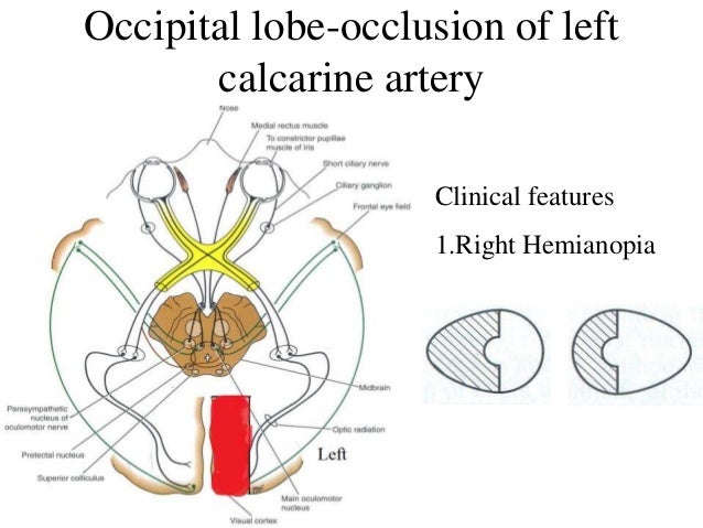 localization of stroke, CVS, stroke, for post graduates