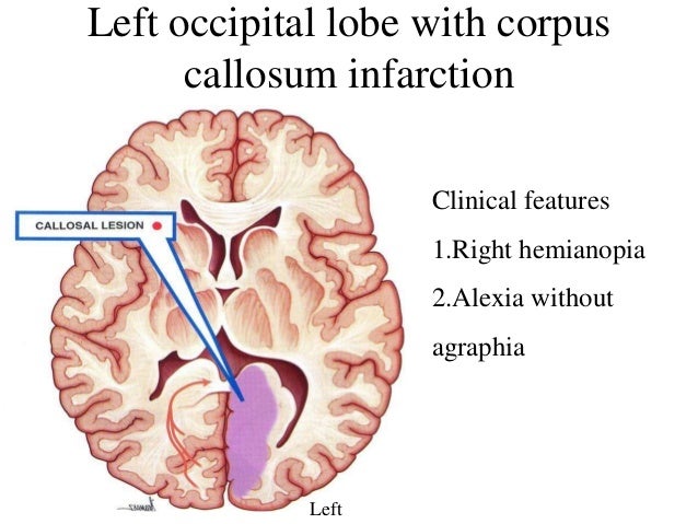 localization of stroke, CVS, stroke, for post graduates