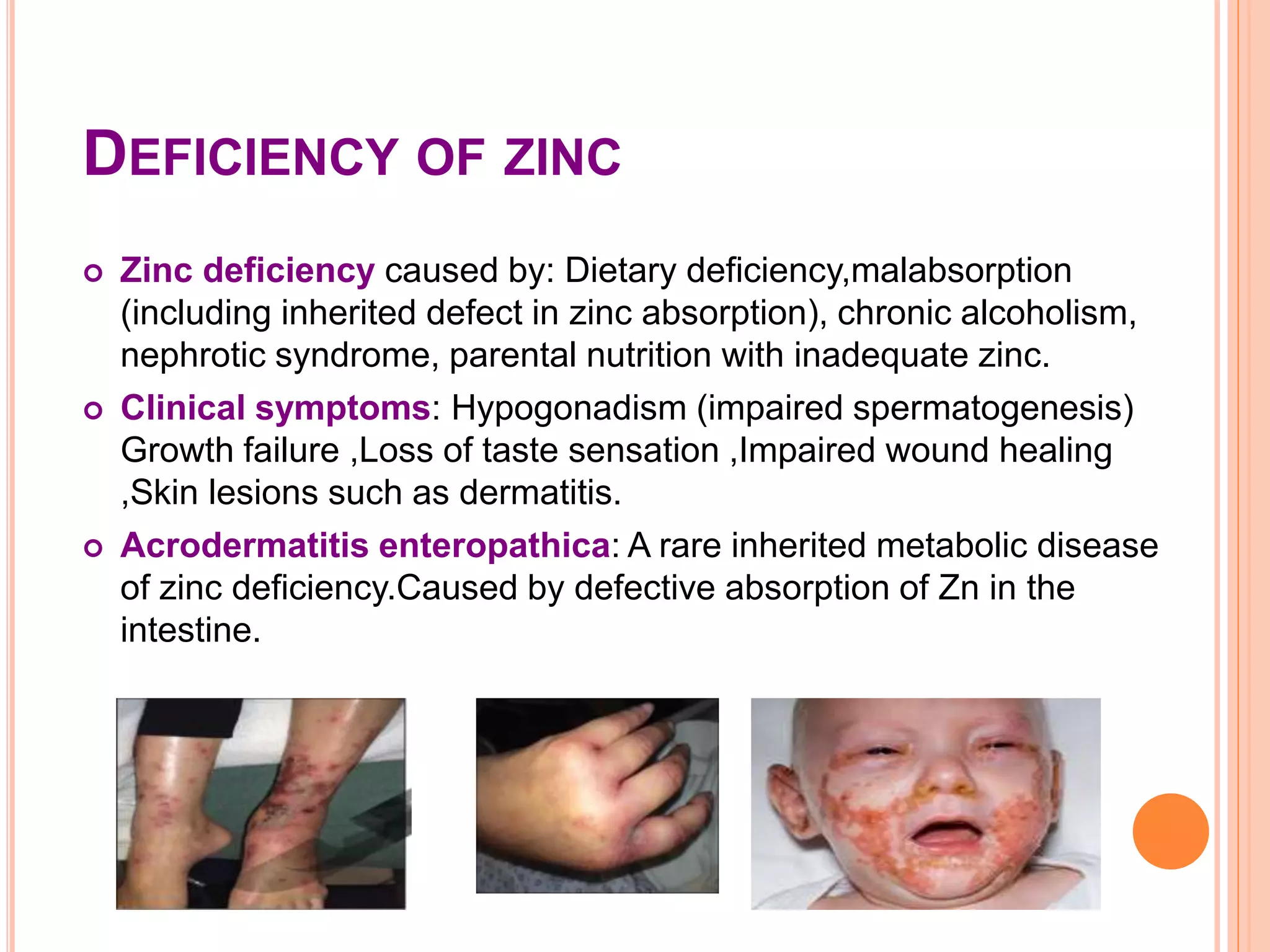 zinc toxicity | PPTX