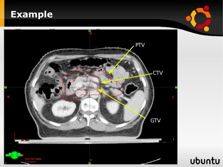New Techniques in Radiotherapy